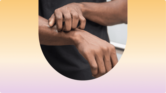 Understanding Anxiety Itching: Why It Happens and How to Manage It | NOCD