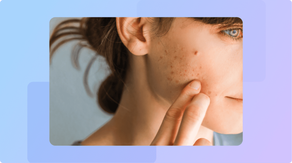 How to stop picking pimples – and when to seek treatment | NOCD