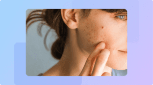 Compulsive skin picking causes and how to stop