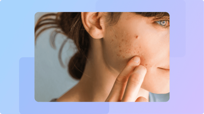 Compulsive skin picking causes and how to stop